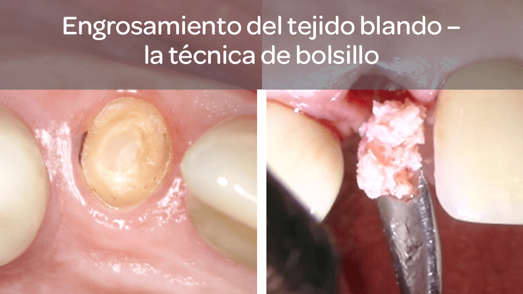 Matriz tisular reconstructiva NovoMatrix®