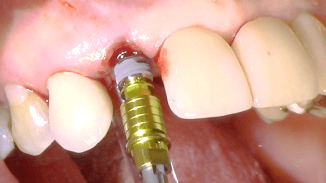 Matriz tisular reconstructiva NovoMatrix®