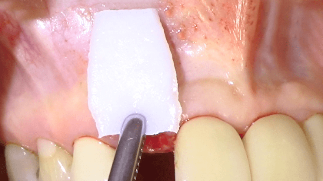 Matriz tisular reconstructiva NovoMatrix®