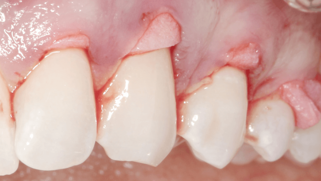 Matriz tisular reconstructiva NovoMatrix®