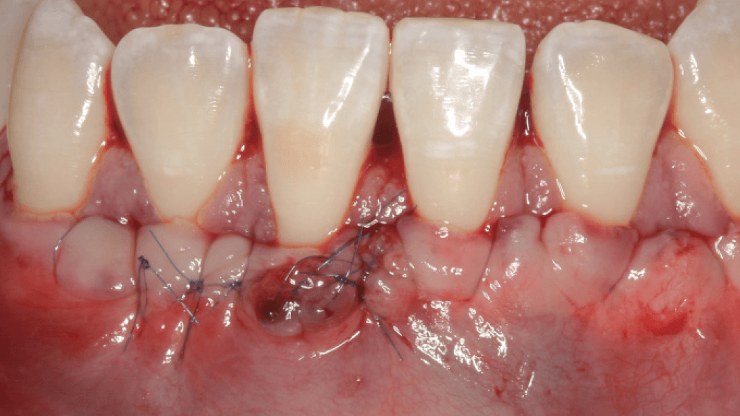 Matriz tisular reconstructiva NovoMatrix®