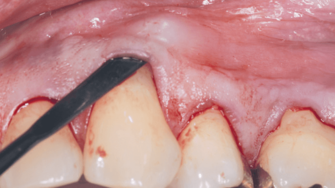 Matriz tisular reconstructiva NovoMatrix®