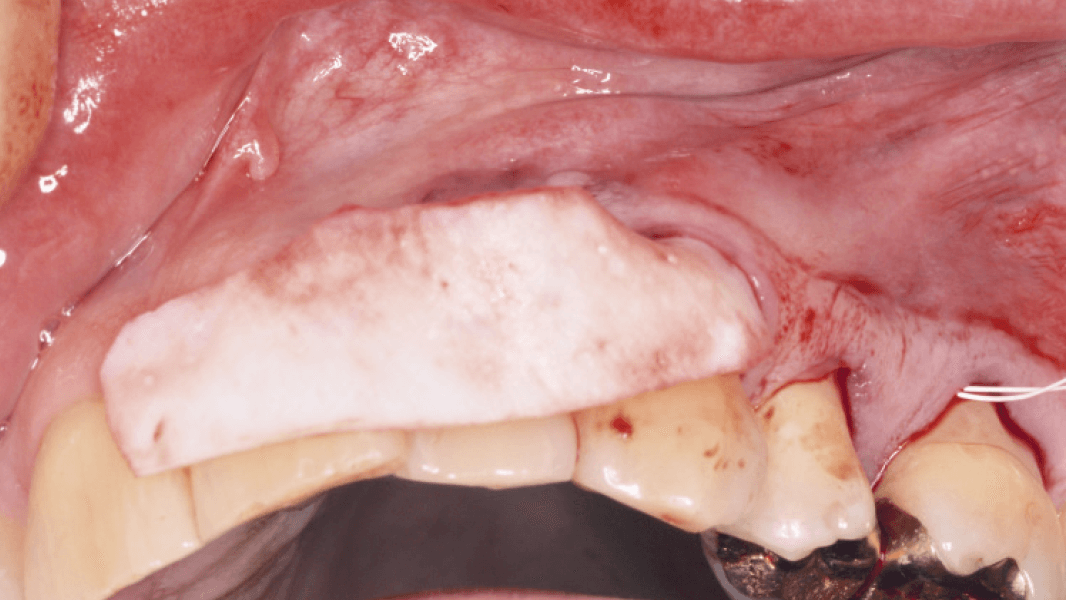 Matriz tisular reconstructiva NovoMatrix®