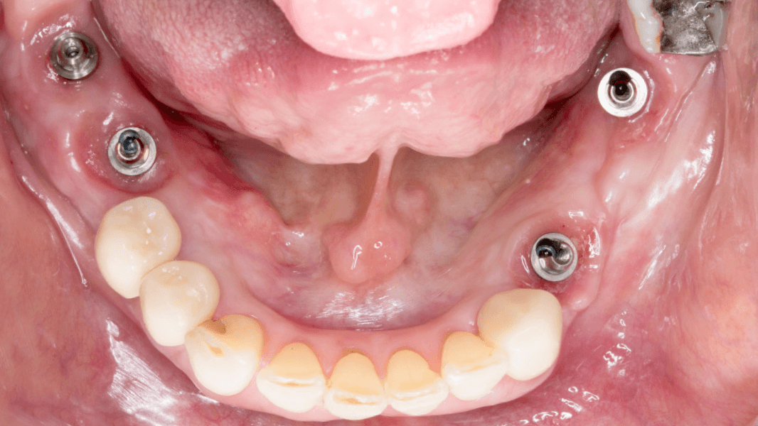 Matriz tisular reconstructiva NovoMatrix®